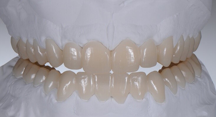 Eierschalen Provisorium / Mock Up - Wilhelmy Zahntechnik